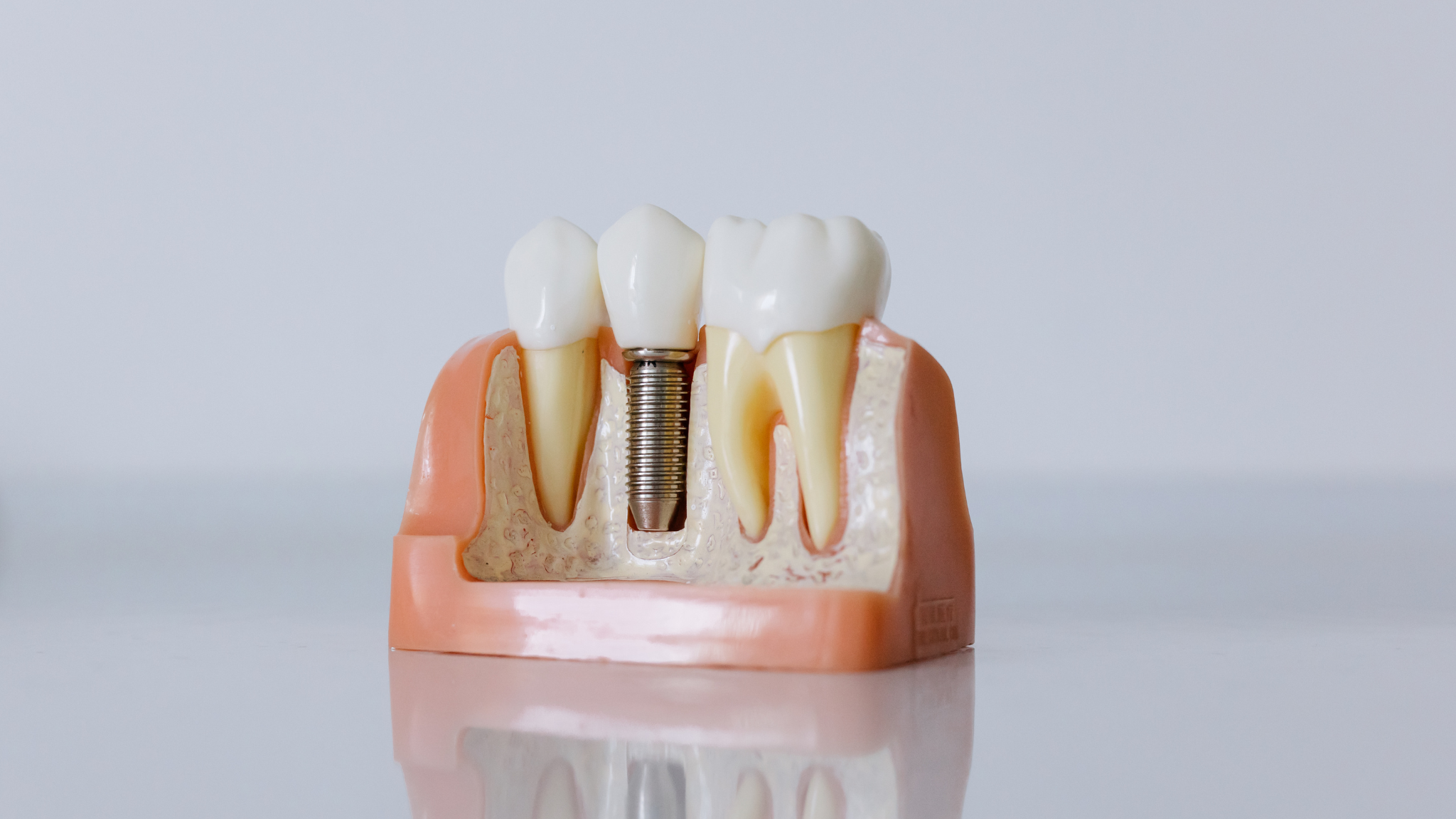 Dental Implant Post-Op Instructions | Health Centered Dentistry